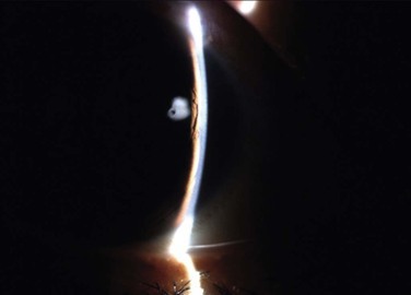 Shallow Anterior Chamber