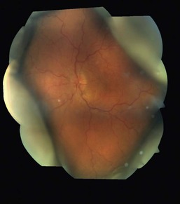 Choroidal Effusion