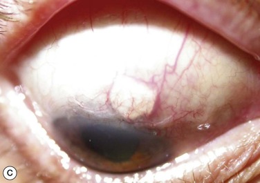 Blebitis and Endophthalmitis