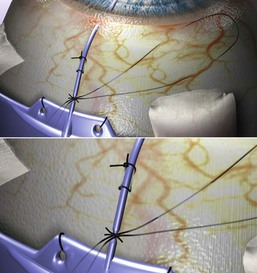 Surgical Technique 2 (Baerveldt Glaucoma Implant)