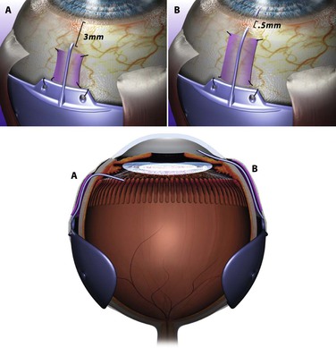 Surgical Technique 2 (Baerveldt Glaucoma Implant)