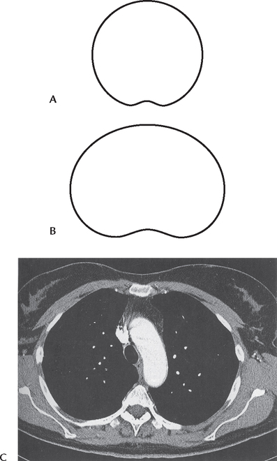 Chapter 14: Introduction to Thorax and Thoracic Cage