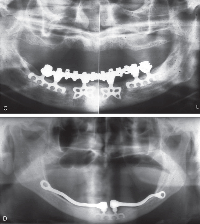 Prosthodontic Treatment for Edentulous Patients: Complete Dentures and ...