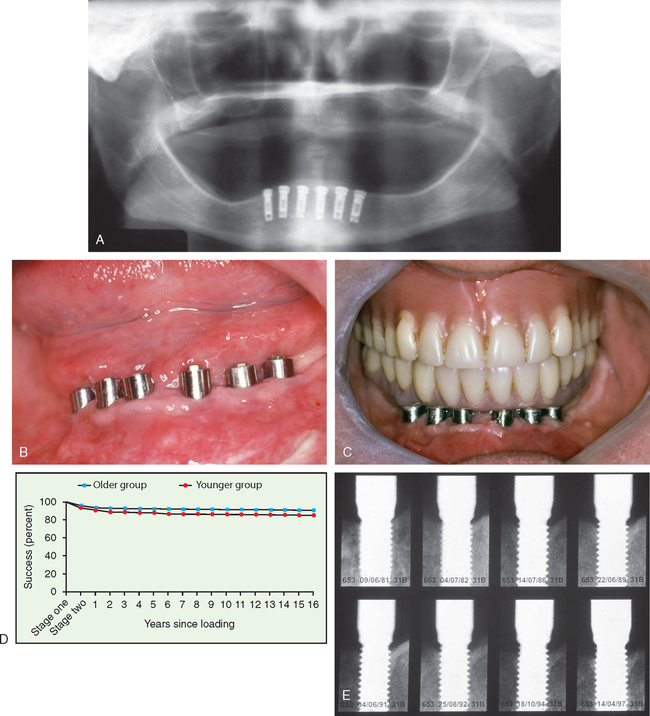 Prosthodontic Treatment for Edentulous Patients: Complete Dentures and ...