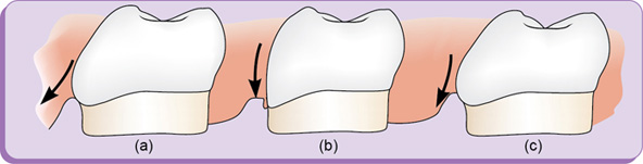 Preclinical Manual of Conservative Dentistry and Endodontics