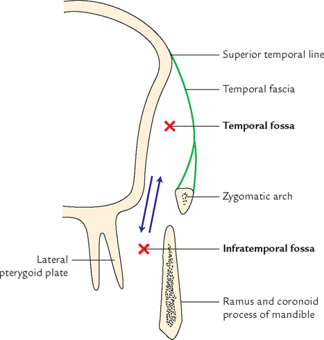 Chapter 10: Infratemporal Fossa, Temporomandibular Joint, and Pterygo ...