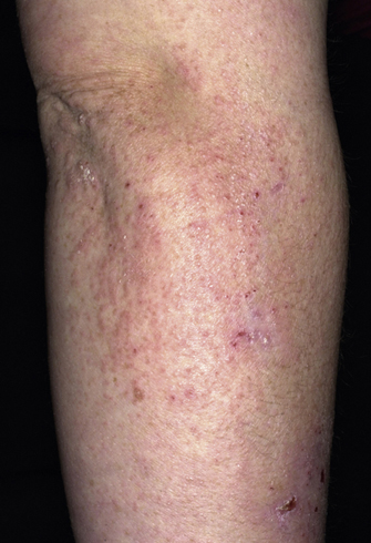 Clinical Dermatology : A Color Guide to Diagnosis and Therapy