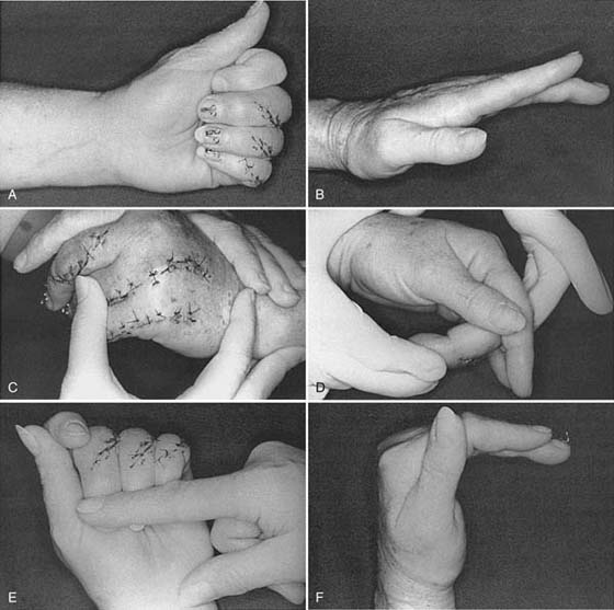 Rehabilitation of the Hand and Upper Extremity