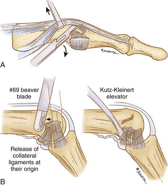 Rehabilitation of the Hand and Upper Extremity