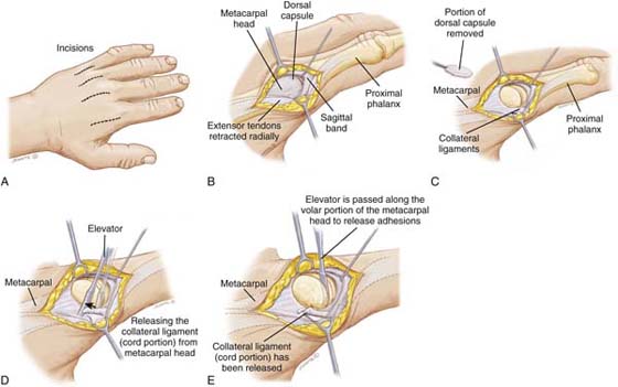 Rehabilitation of the Hand and Upper Extremity